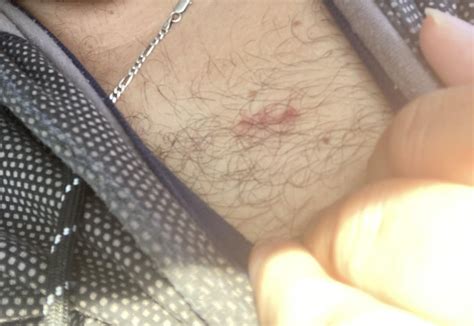 Scar From Mole Excision Is Irritating Me When I Have A Shirt On R