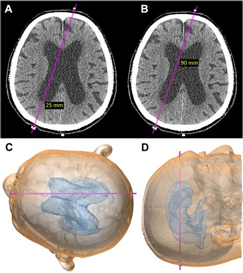 Codman Programmable Shunt Brain Codman Programmable Shunt Brain