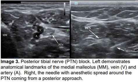 Diagnostic Posterior Tibial Nerve Block Sports Medicine Review