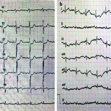 A 12 Lead Electrocardiogram Shows St Segment Depression In Anterior Download Scientific