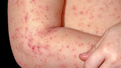Little Red Spots On Skin