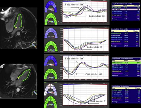 Diffuse Interstitial Fibrosis And Myocardial Dysfunction In Early Chronic Kidney Disease