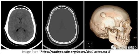 【推荐】颅骨肿瘤之良性肿瘤 脑医汇