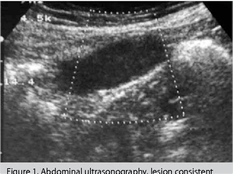 Figure 1 From Appendiceal Mucocele Mimicking Urolithiasis Semantic Scholar