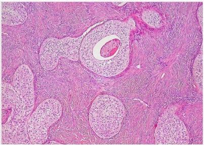 Βenign Brenner Tumor Of The Ovary With Unusual Large Size A Case