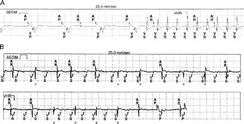 Stored Intracardiac Electrograms Egms Of Type 3 Patient With Complete Download Scientific