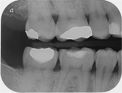 Bitewing Xrays 4 Buyxraysonline