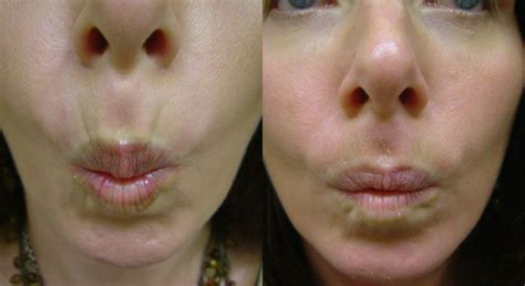 Upper Lip Botox Before And After