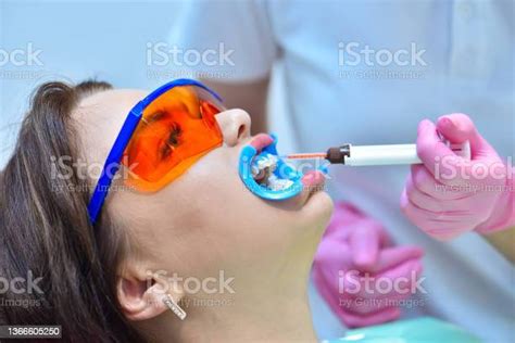 분홍색 장갑을 낀 치과 의사는 치과 진료소에서 환자의 치아에 미백 젤을 적용합니다 건강 진단에 대한 스톡 사진 및 기타 이미지 건강 진단 건강관리와 의술 레이저