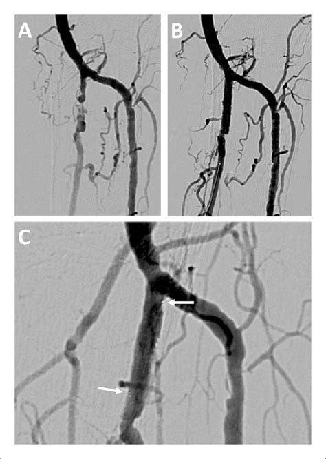 A A Diffuse Atherosclerotic Lesion Affecting The Tibioperoneal Trunk Download Scientific