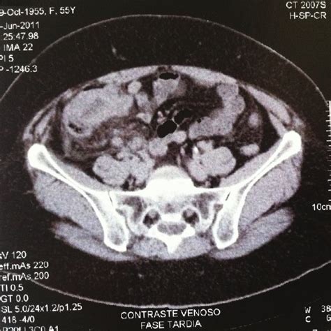 Surgical Specimen From Ileocolectomy Showing Mucosal Surface Without Download Scientific