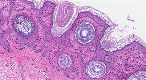 Seborrheic Keratosis Mypathologyreportca