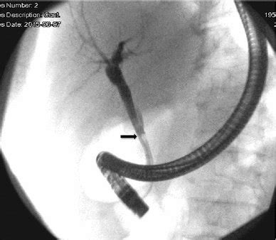 Representative ERCP Image Showing Filling Defects In The Middle Portion Download Scientific