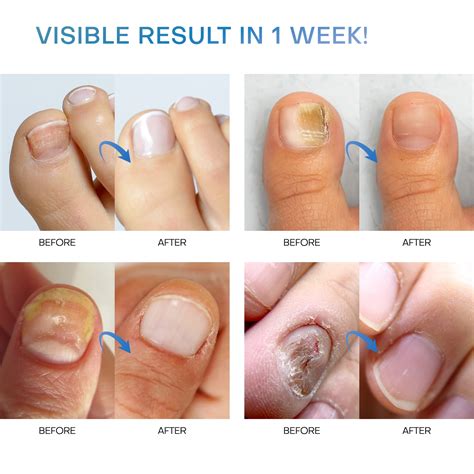 Toe Polish For Nail Fungus