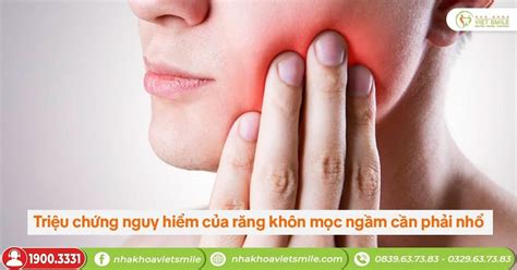 Nhổ Răng Khôn Mọc Ngầm Như Thế Nào Và Giá Bao Nhiêu