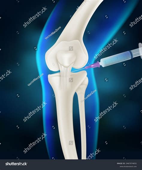 Injection Into Knee Joint Drug Treatment Stock Vector Royalty Free 2467074831 Shutterstock