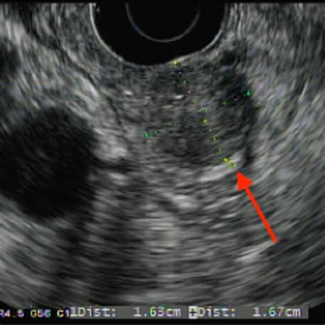 Eus 82013 Initial Diagnosis Arrow Pointing To 16 Cm × 16 Cm