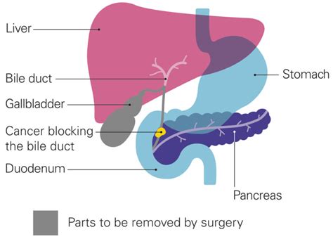 What Does Bypass Surgery Involve Pancreatic Cancer Uk