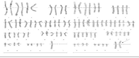 Table 1 From Iranian Journal Of Basic Medical Sciences Frequency And The Type Of Chromosomal