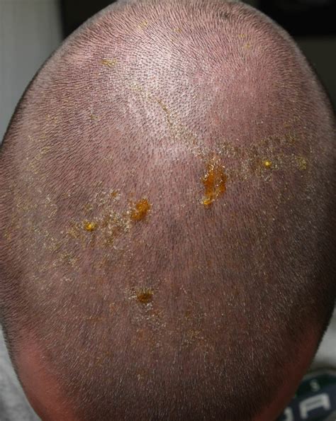 Sunburn On Scalp Causes Symptoms Treatment Prevention And More Healthroid