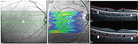First Measurement Protocol EDI SD OCT Raster Scan Protocol Left Download Scientific Diagram