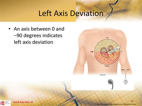 Ppt 12 Lead Ecgs And Electrical Axis Powerpoint Presentation Free