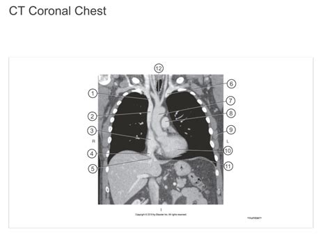 Coronal Chest Ct Diagram Quizlet