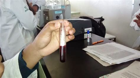 RetracciÓn Del Coagulo