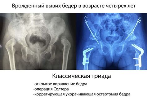 Подвывих Тазобедренного Сустава У Детей 57 Фотo