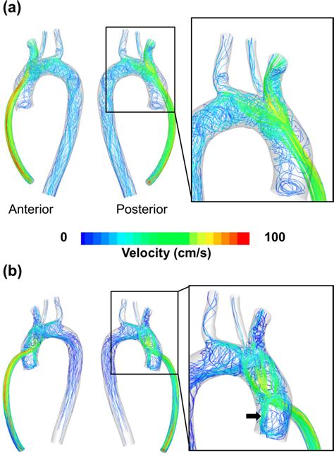 Lvad Outflow Graft Angle And Thrombosis Risk Abstract Europe Pmc