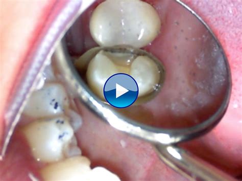 Greater Curve Matrix Class Ii Restoration Dentistry Today