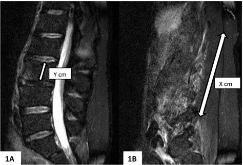 Paraspinal Soft Tissue Edema Ratio An Accurate Marker For Early Lumbar