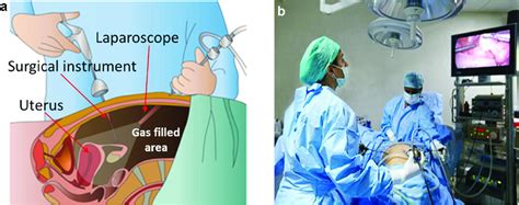 A Laparoscopic Surgery B Surgeons Viewing Inside The Abdomen On