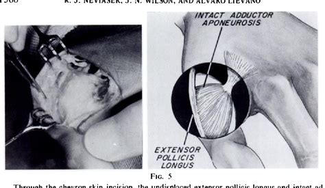Metacarpophalangeal Joint Structure Semantic Scholar