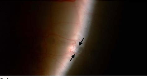 Pdf Conjunctival Intraepithelial Microcyst Semantic Scholar