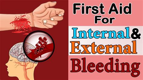 Bleeding First Aid