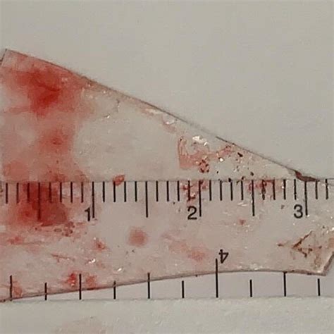 The 35 Cm Glass Foreign Body Identified In The Right Inguinal Region Download Scientific