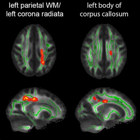 A Tract Based Spatial Statistics Tbss Results Showing Significantly