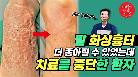 안타까운 마음에 소개해드립니다 화상 흉터 치료를 꾸준하게 받아야 하는 이유 미소사랑의원 Youtube