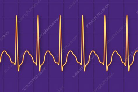 Atrial Flutter Abnormal Heartbeat Rhythm Illustration Stock Image F0417682 Science Photo