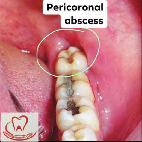 Types Of Dental Abscess 👇🏼🦷😯 📌 Periapical Abscess It Form At Root Tip