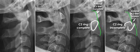 C2 Spine Fracture