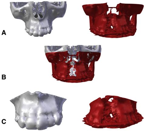 Three Dimensional 3d Reconstruction Of The Maxilla A 3d Download Scientific Diagram