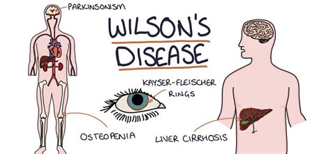 Wilsons Disease Liver