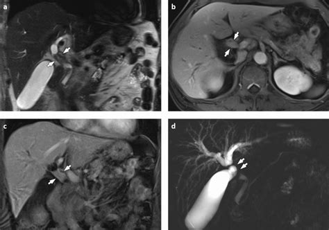 A 67 Year Old Man With Perihilar Cholangiocarcinoma In The R0 Resection