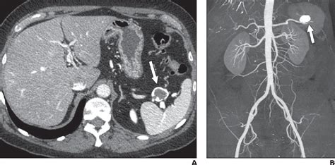Figure 12 From Pancreatic Calcifications And Calcified Pancreatic