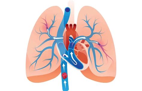 Mastering Pulmonary Embolism Key Insights Medbrane