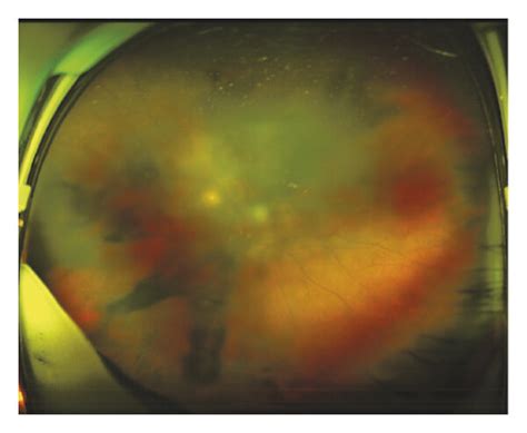 Patient 10 With Iris Defect And Localized Cataract A Anterior Download Scientific Diagram