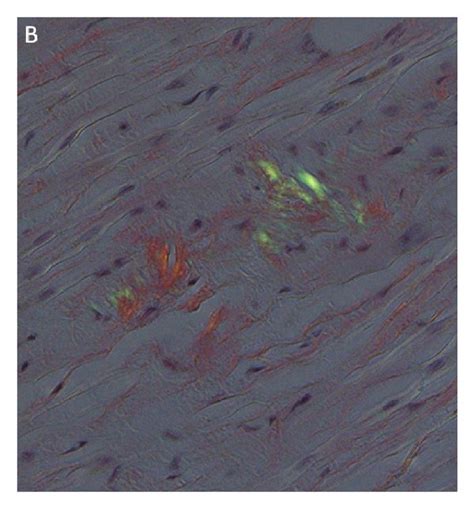 Cardiac Amyloidosis A Congo Red Stain Of Left Ventricle Showing