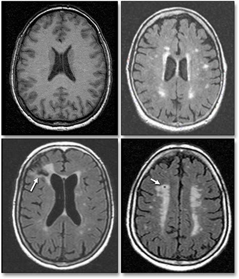 Left Atrial Volumes And Reservoir Function Are Associated With Subclinical Cerebrovascular